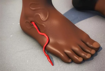 Global Eradication of Guinea Worm Disease Nears, Despite Complications