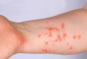 Monkeypox: U.S. Has the Tools to Respond to Outbreak