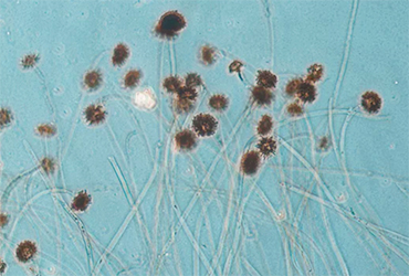 Fatal Triazole-Resistant Aspergillus fumigatus Infection Linked to ...