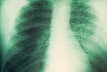 Pneumonic Plague Case Exposes Difficulties of Diagnosing Rare Diseases ...