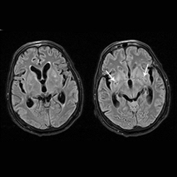 Meningococcal Disease CDC Alert