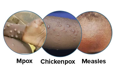 Mpox Outbreak Uganda varicella zoster CROI 2025