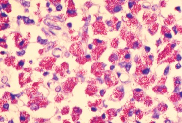 MAC Disease Children HIV